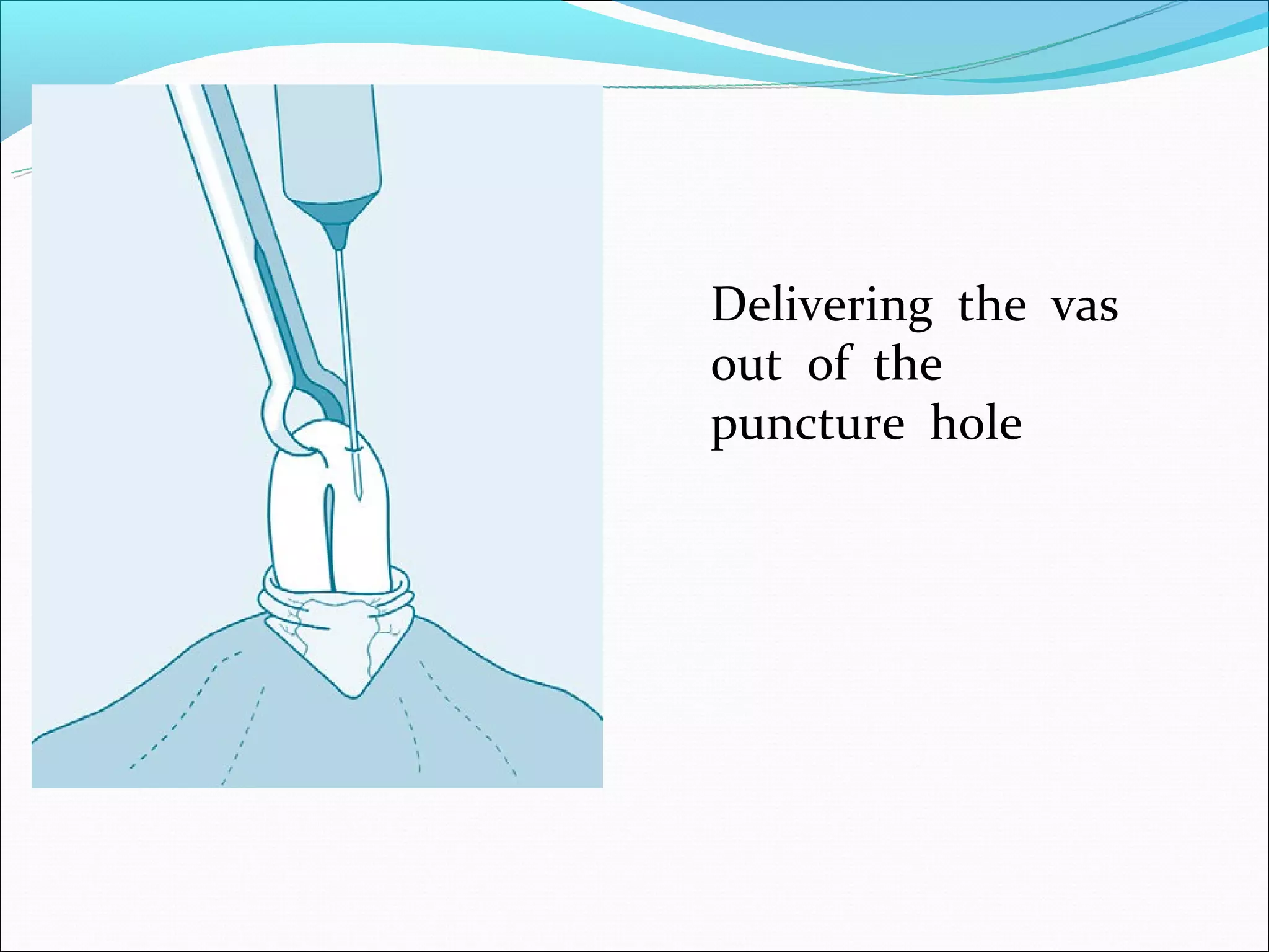No- scalpel vasectomy | PPT
