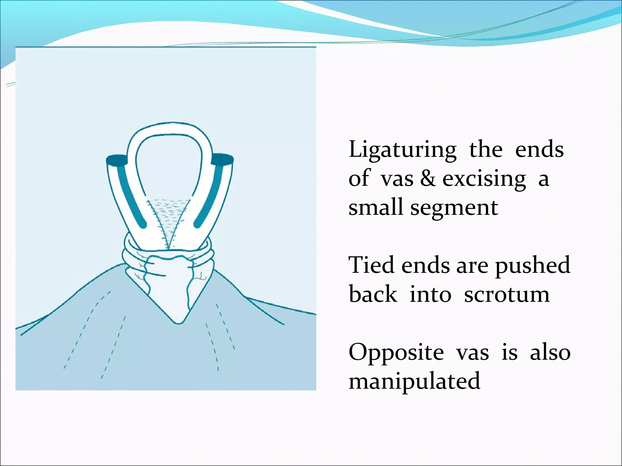 No- scalpel vasectomy | PPT