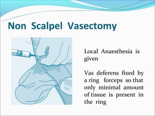 No- scalpel vasectomy | PPT