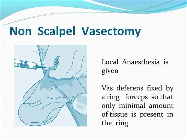 No- scalpel vasectomy | PPT
