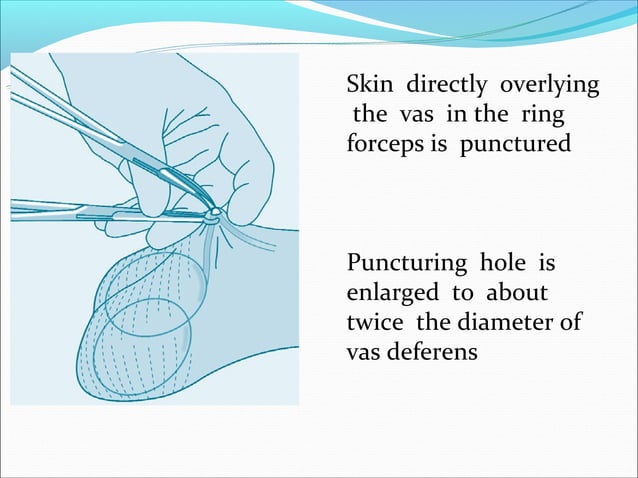 No- scalpel vasectomy | PPT | Infertility | Reproductive Health