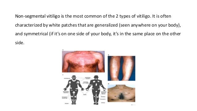 Vitiligo: Types, Symptoms, Causes, Treatment & Recovery |IQ learning | PPTX