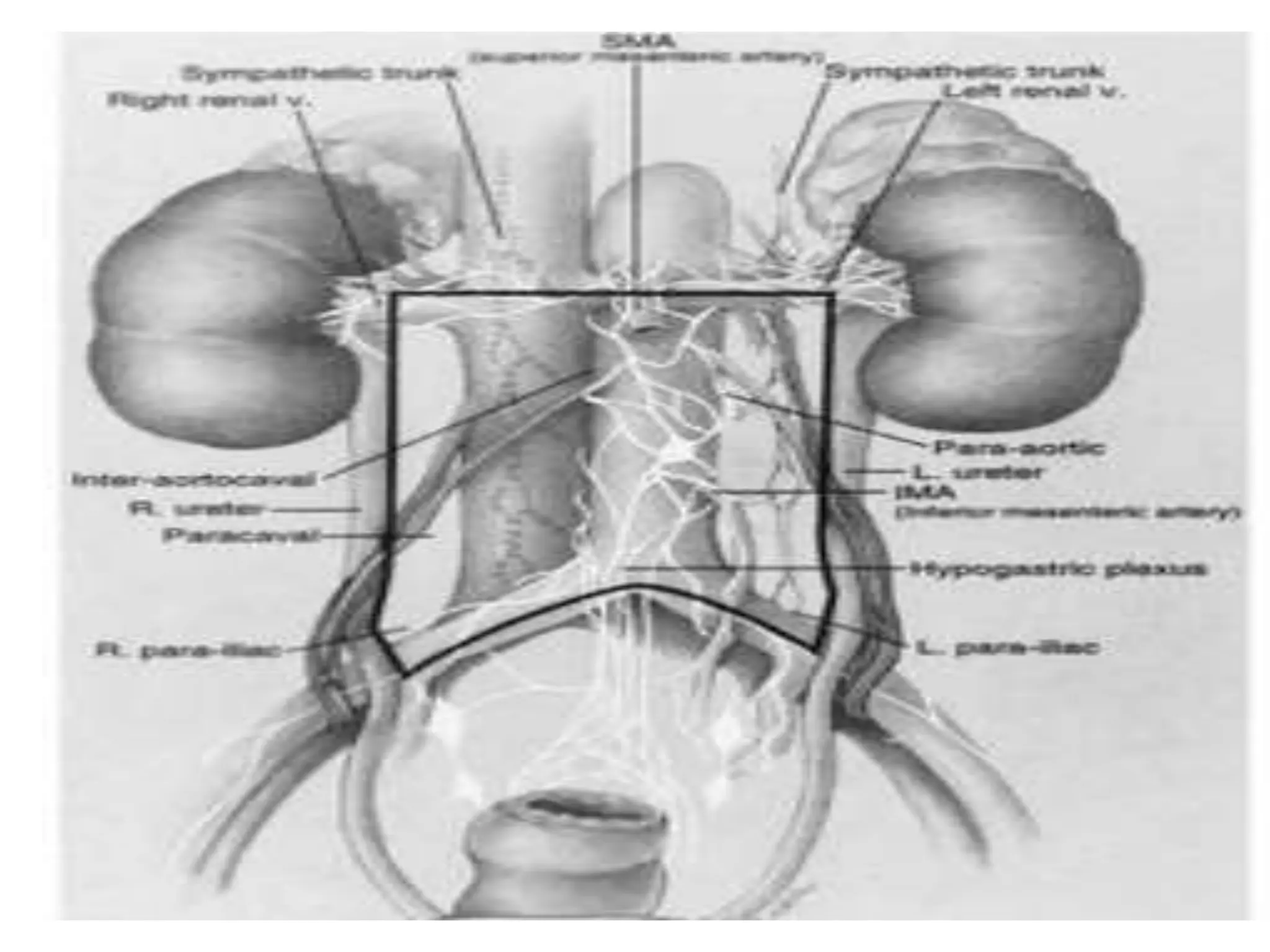 Non Seminoma Germ Cell Tumor Management Pptx