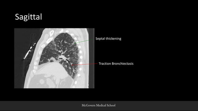 Nonspecific-Interstitial-Pneumonia-NSIP-Interstitial-Lung-Disease-ILD ...
