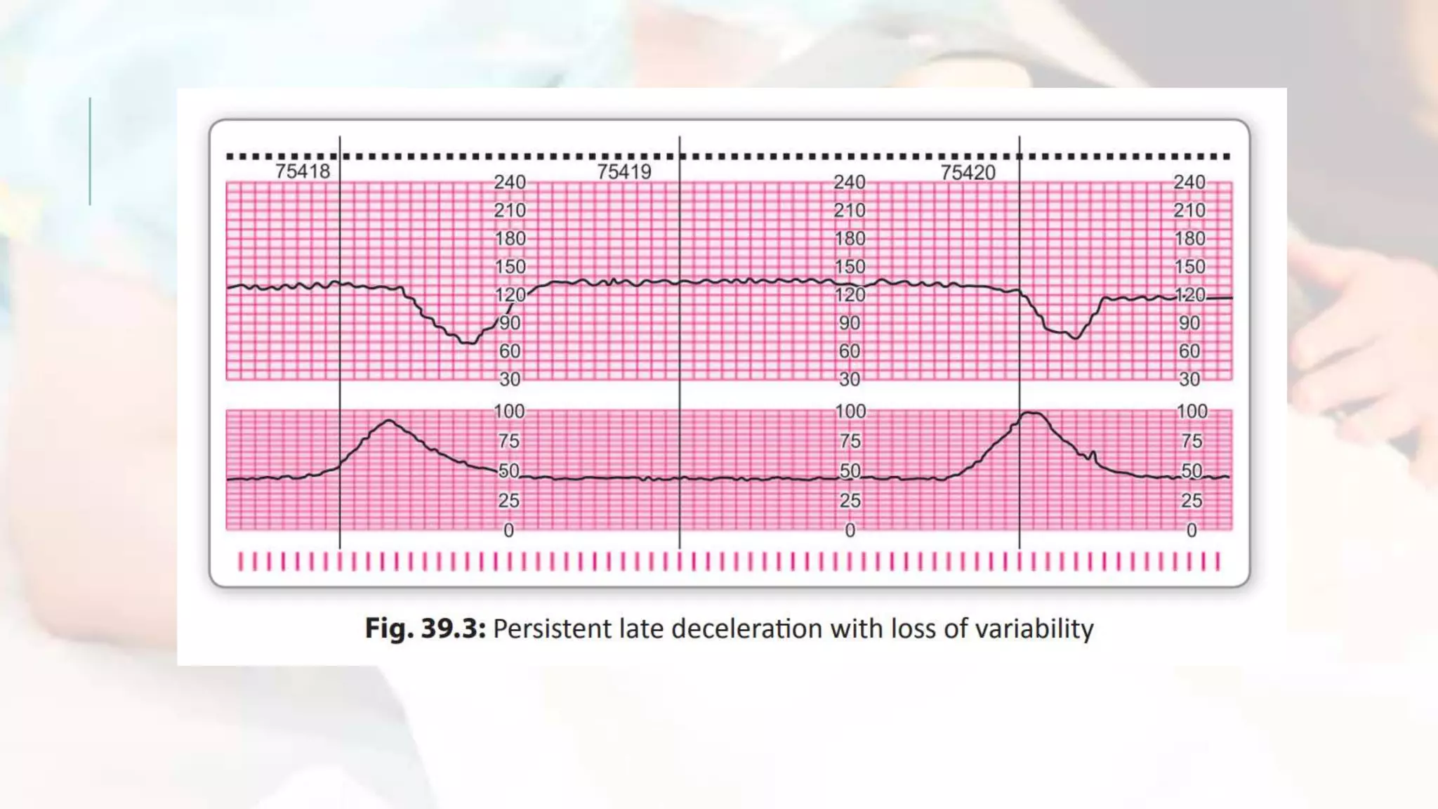 Non stress test | PPTX
