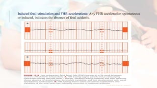 Non stress test | PPTX