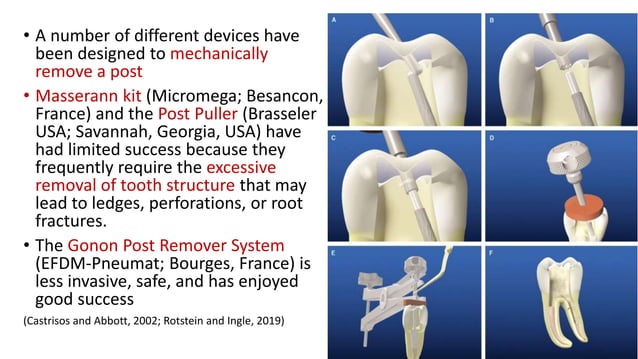 non surgical endodontic retreatment.pptx