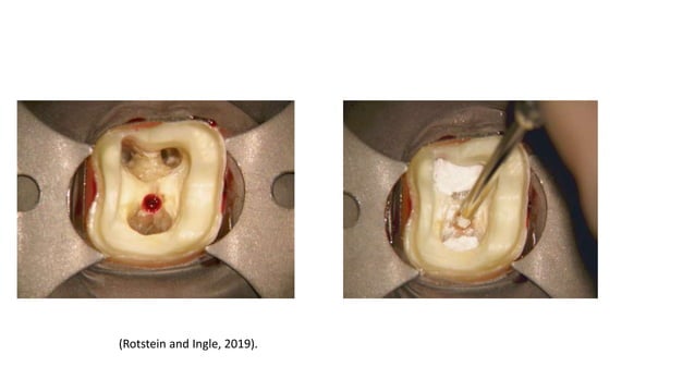 non surgical endodontic retreatment.pptx