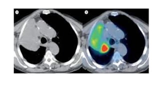 Non Surgical Management of Bladder and Lung Cacer.pptx
