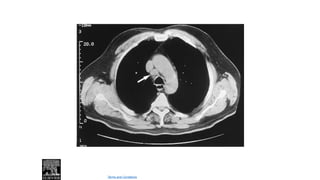 Non Surgical Management of Bladder and Lung Cacer.pptx
