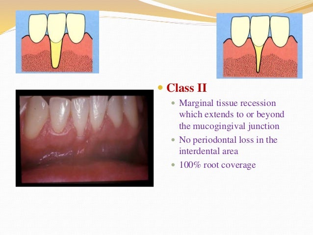Non surgical management of gingival recession- Dr Harshavardhan Pa…