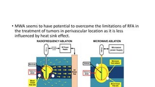 NON SURGICAL MANAGEMENT OF HEPATOCELLULAR CARCINOMA1.pptx