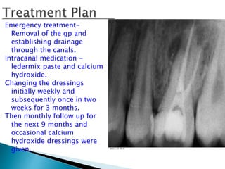 Nonsurgical management of large periapical lesions | PPTX