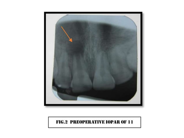 Non surgical management of large periapical radiolucency | PPT