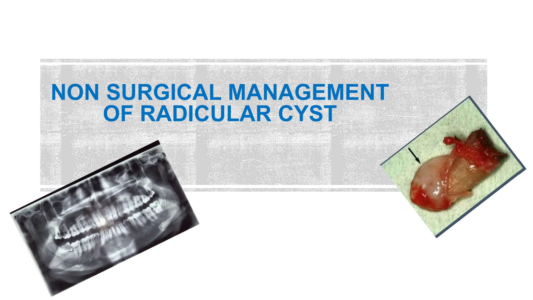 NON SURGICAL MANAGEMENT OF RADICULAR CYST.pptx | Dental Health ...