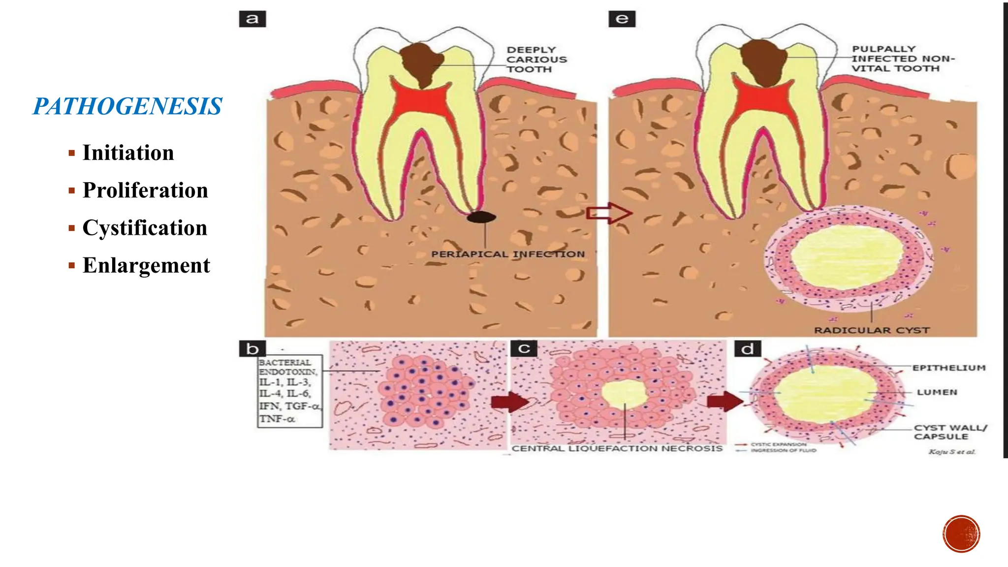 NON SURGICAL MANAGEMENT OF RADICULAR CYST.pptx | Dental Health ...