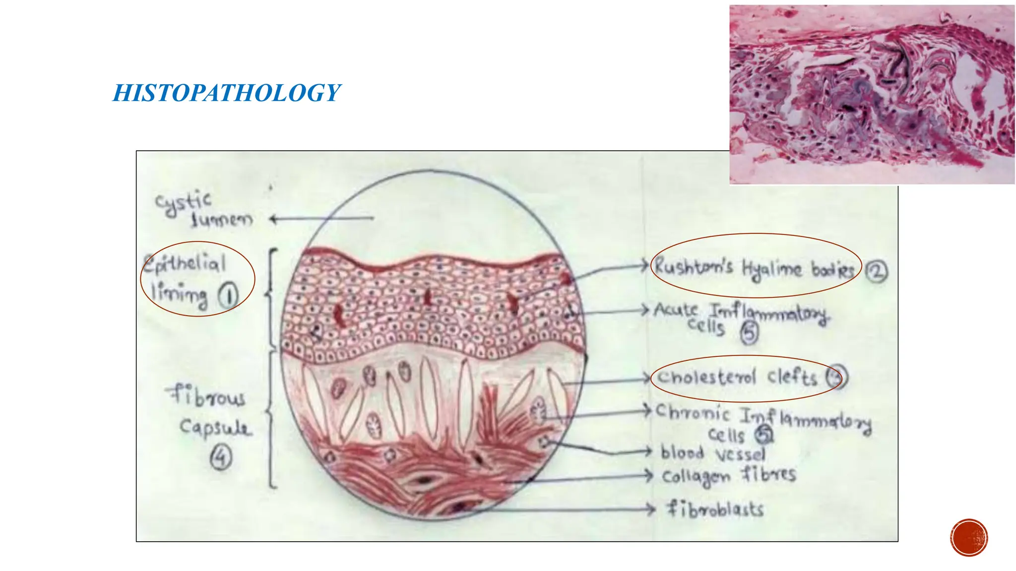 NON SURGICAL MANAGEMENT OF RADICULAR CYST.pptx | Dental Health ...