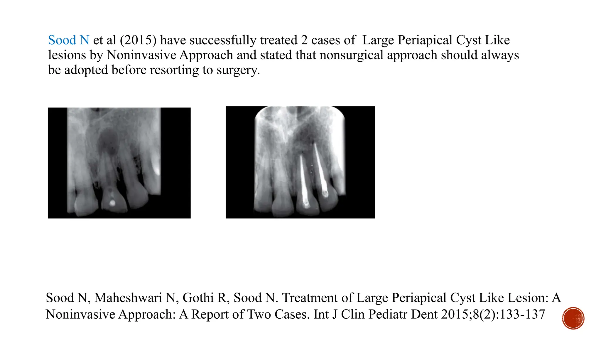 NON SURGICAL MANAGEMENT OF RADICULAR CYST.pptx | Dental Health ...