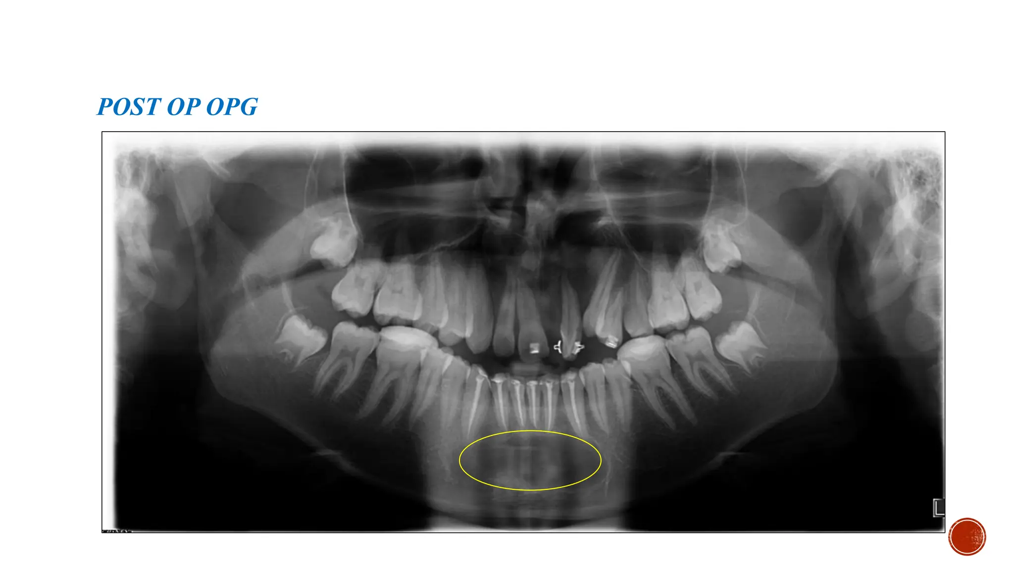 NON SURGICAL MANAGEMENT OF RADICULAR CYST.pptx | Dental Health ...