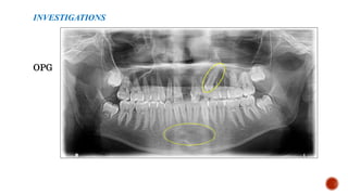 NON SURGICAL MANAGEMENT OF RADICULAR CYST.pptx