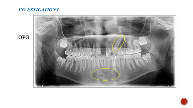 NON SURGICAL MANAGEMENT OF RADICULAR CYST.pptx