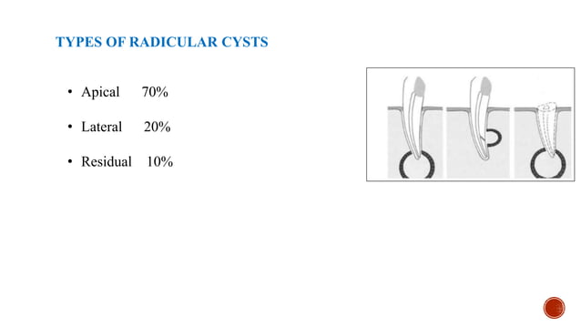 NON SURGICAL MANAGEMENT OF RADICULAR CYST.pptx