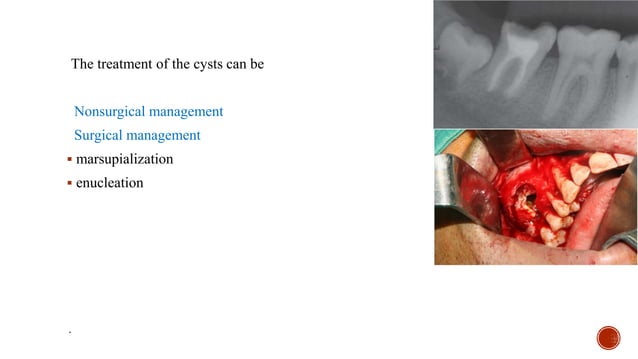 NON SURGICAL MANAGEMENT OF RADICULAR CYST.pptx