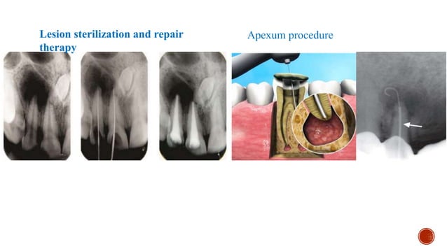 NON SURGICAL MANAGEMENT OF RADICULAR CYST.pptx