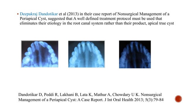 NON SURGICAL MANAGEMENT OF RADICULAR CYST.pptx