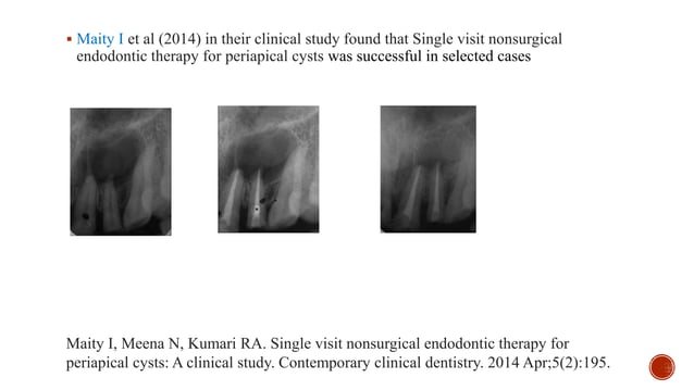 NON SURGICAL MANAGEMENT OF RADICULAR CYST.pptx