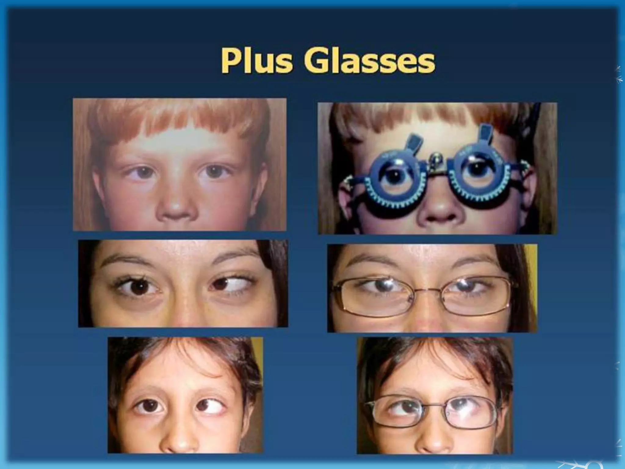 Non surgical management of strabismus .ppt