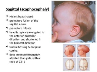 NON SYNDROMIC CRANIOSYNOSTOSIS overview.pptx