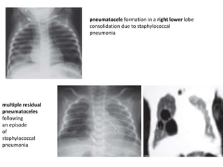 Non tb PULMONARY infection | PPTX