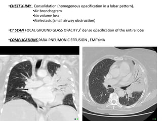 Non tb PULMONARY infection | PPTX
