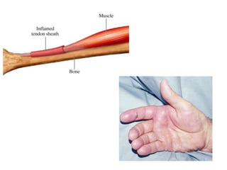 Nontraumatic musculoskeletal disorders | PPT