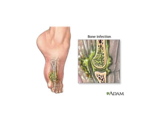 Nontraumatic musculoskeletal disorders | PPT