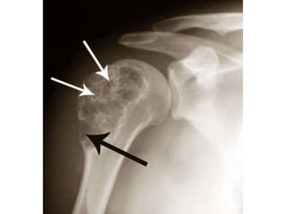 Nontraumatic musculoskeletal disorders | PPT