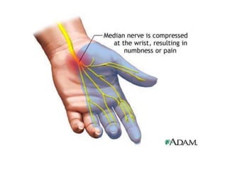 Nontraumatic musculoskeletal disorders | PPT