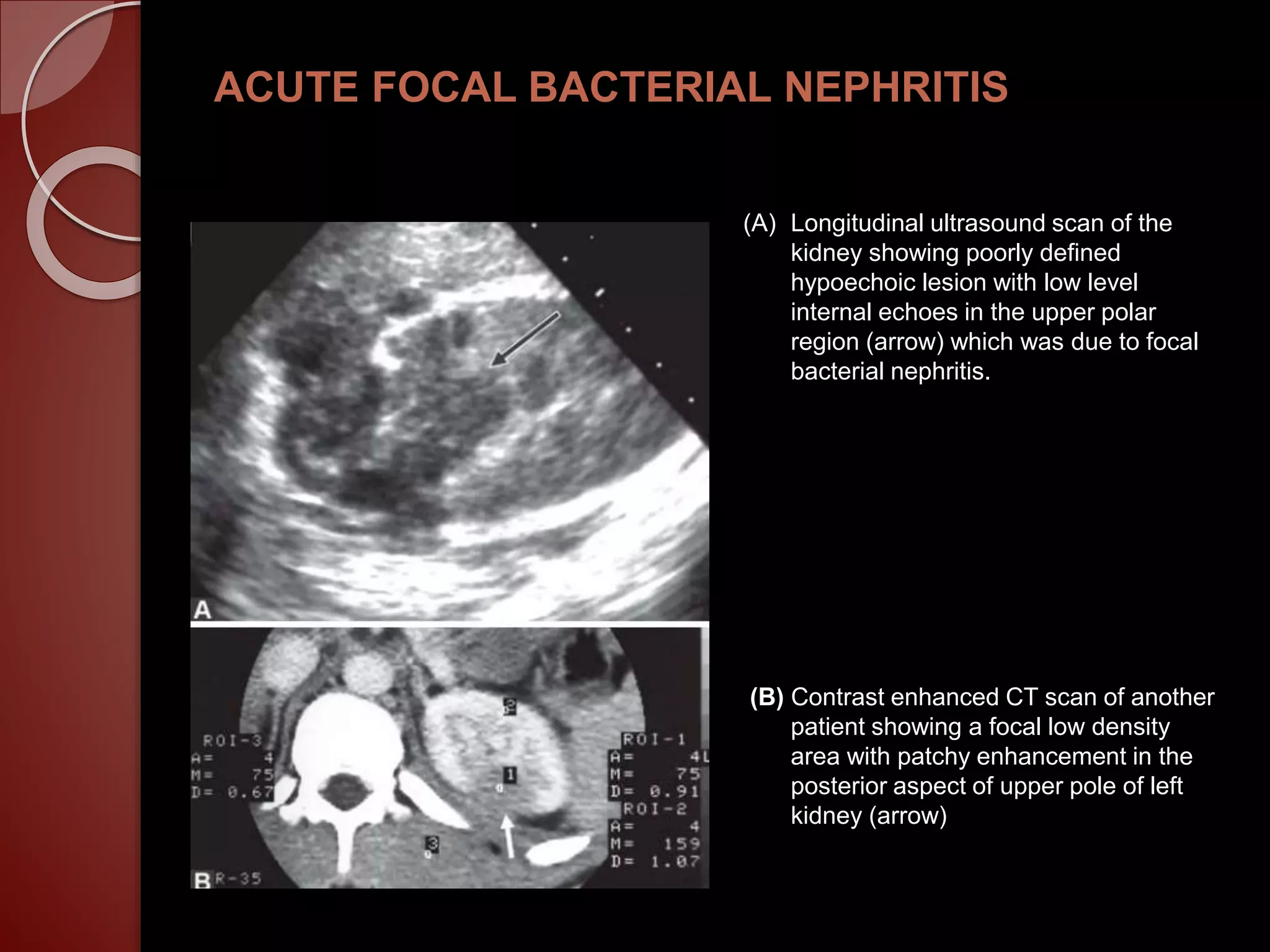 Imaging of Non tubercular infections of the urinary tract | PPTX