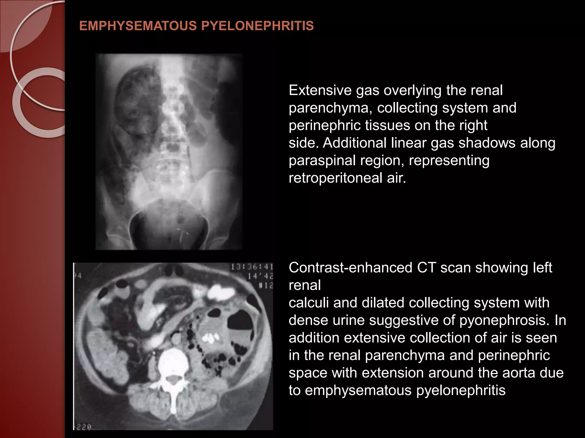 Imaging of Non tubercular infections of the urinary tract | PPTX