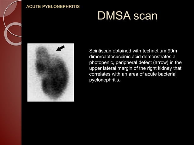 Imaging of Non tubercular infections of the urinary tract | PPTX ...