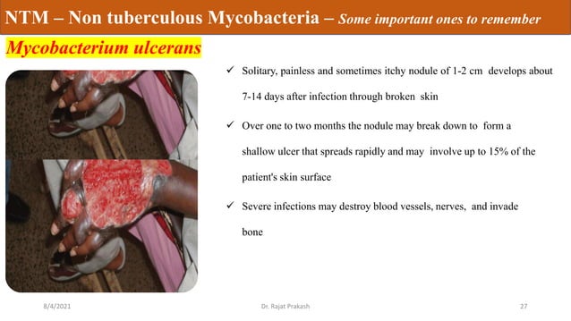 Non tuberculous mycobacteria | PDF
