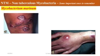 Non tuberculous mycobacteria | PDF