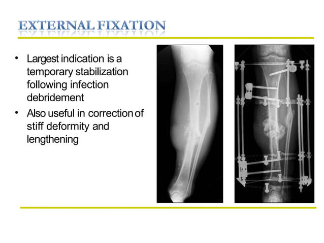 NON UNION AND CHRONIC OSTEOMYELITIS | PPT