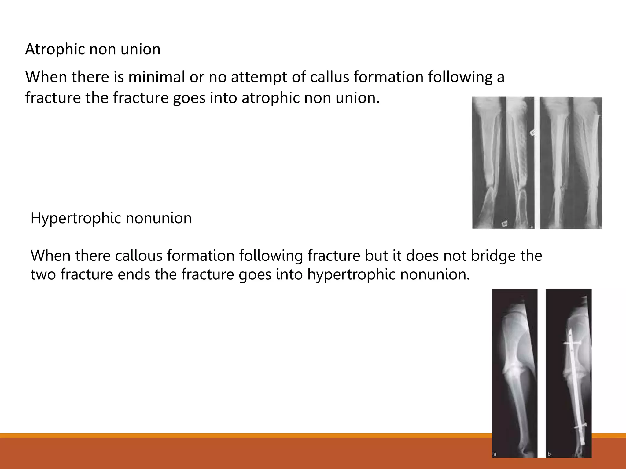 non union and malunion final.pptx