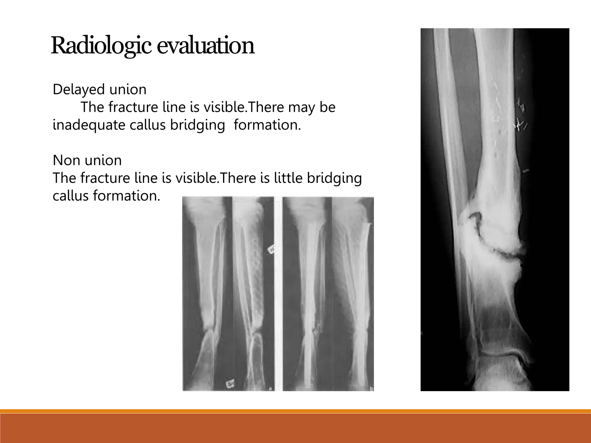 non union and malunion final.pptx