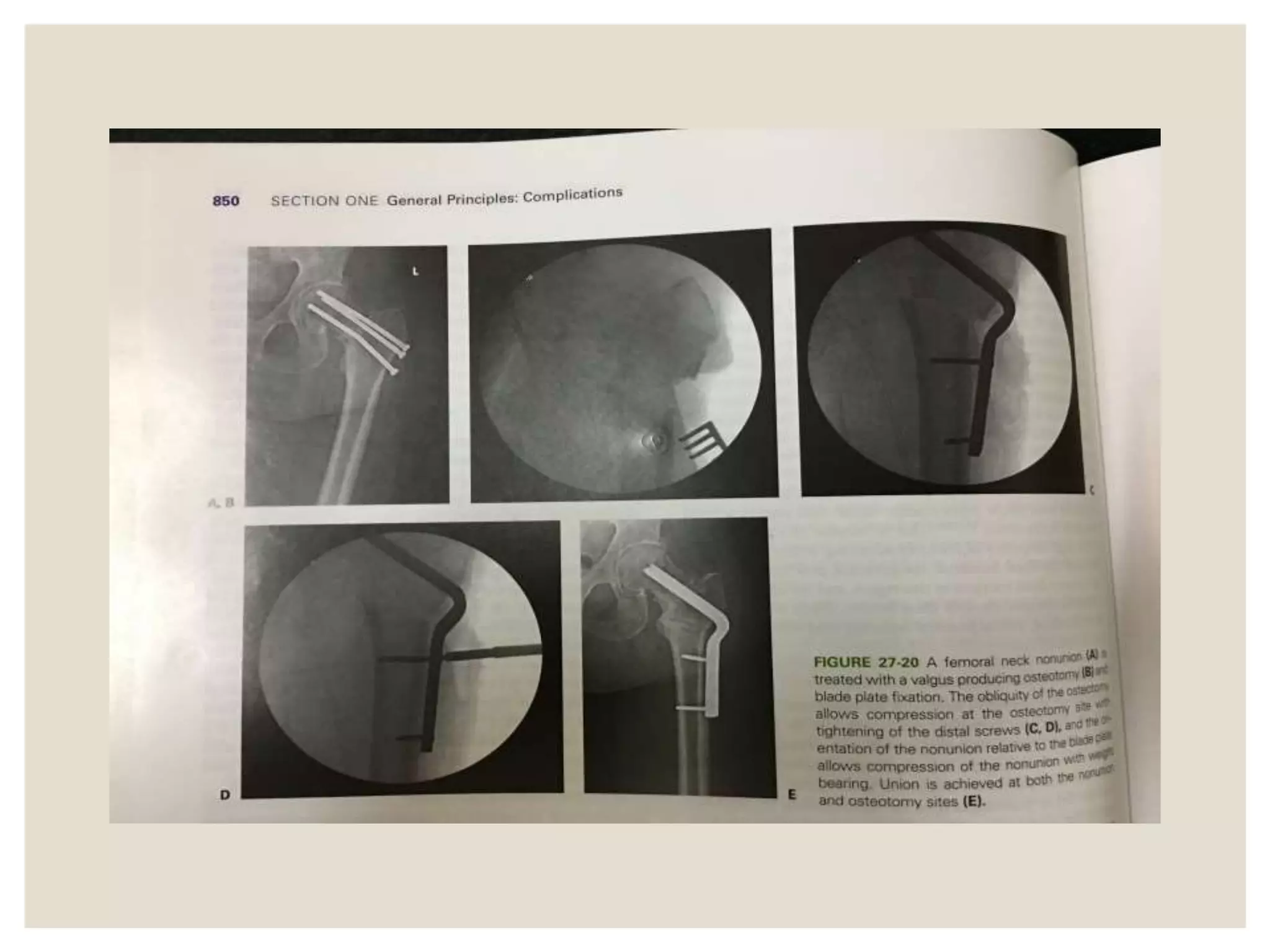 non union and malunion final.pptx