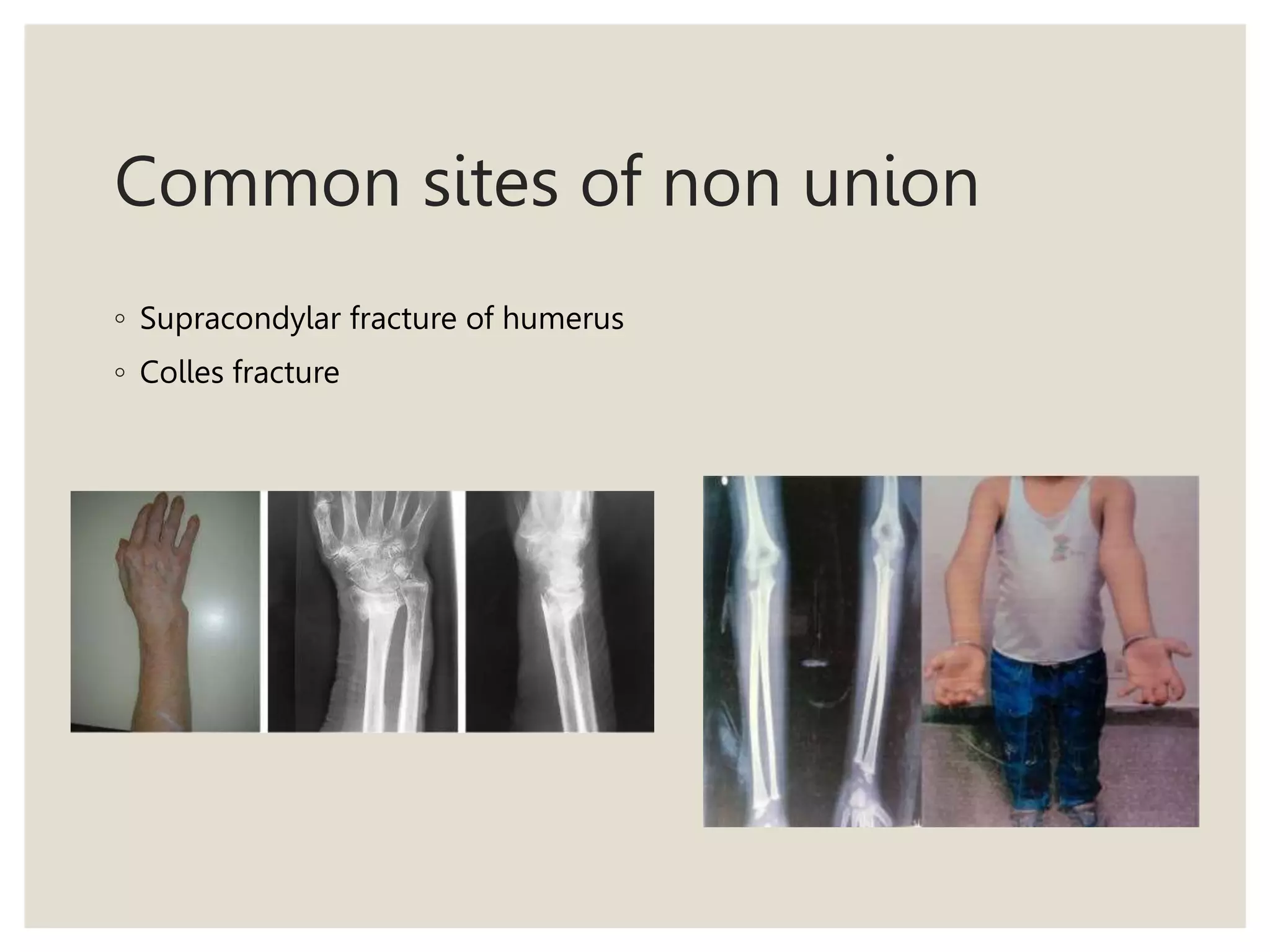 non union and malunion final.pptx