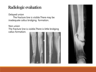 non union and malunion final.pptx