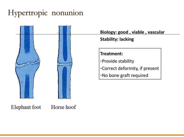 non union and malunion final.pptx